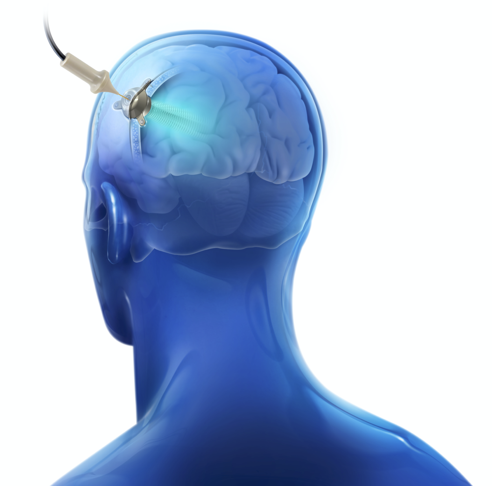 Carthera receives FDA Breakthrough Device Designation for SonoCloud-9 ...