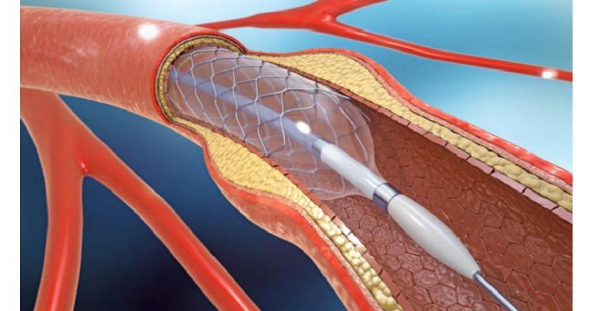SEMS Dominates Esophageal Stents Market As Hospitals Hold Largest Share ...