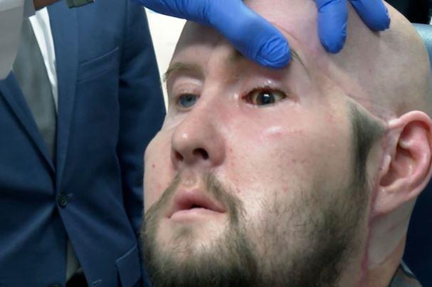 World's First Whole-Eye Transplant Hailed As Breakthrough