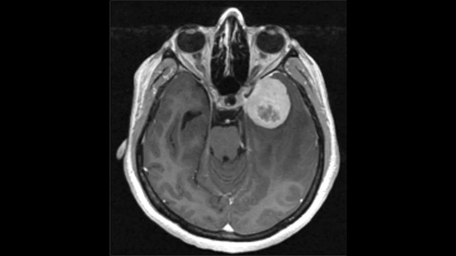 New Genetic Biomarker Flags Aggressive Brain Tumors