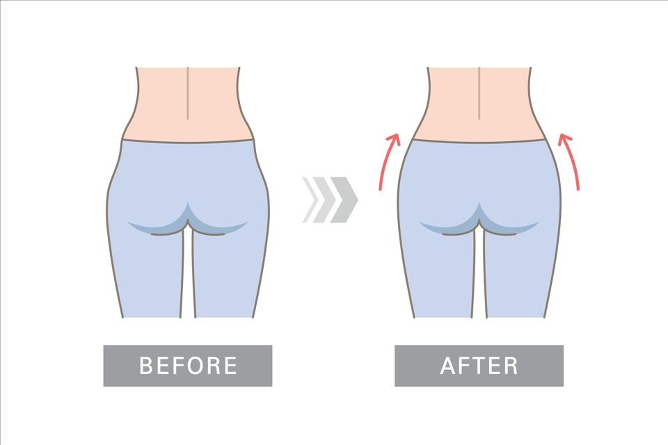 Hip Dips: What Are They And Can You Really Get Rid Of Them?