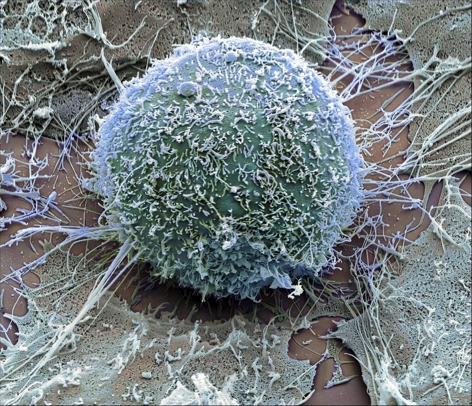 South African Scientists Make Breakthrough In Decoding Cancer's Most ...